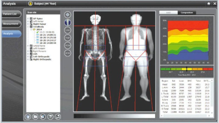 Osteodensitometru whole body Primus Osteosys » Intro.ro